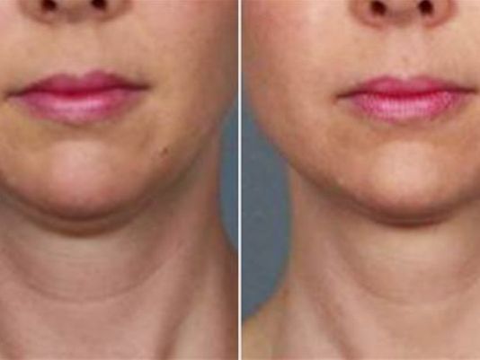 FDA panel recommends 'double chin' injection | 12news.com