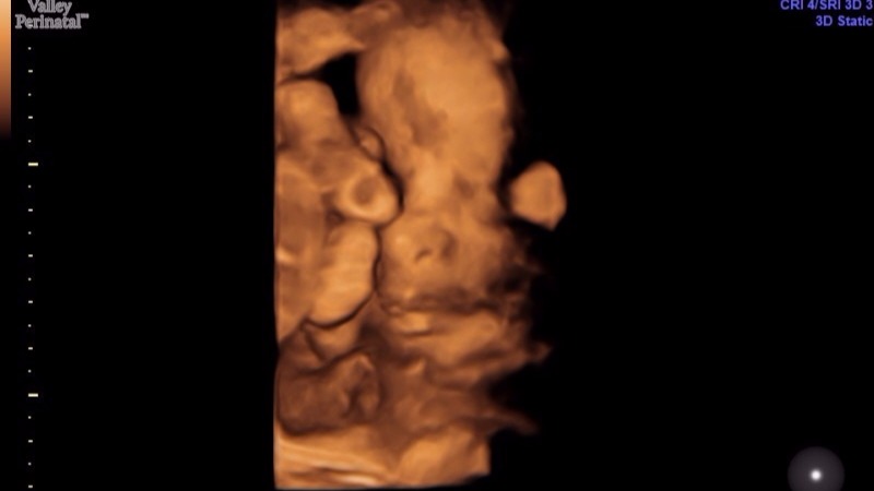 PHOTOS: Phoenix baby born with intestines on the outside of her body ...
