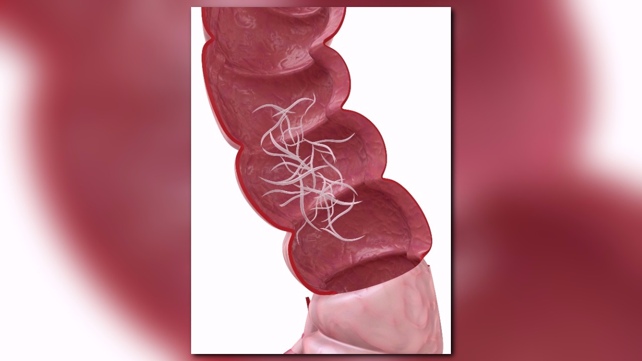 Girl's 'appendicitis' turns out to be worms | kvue.com